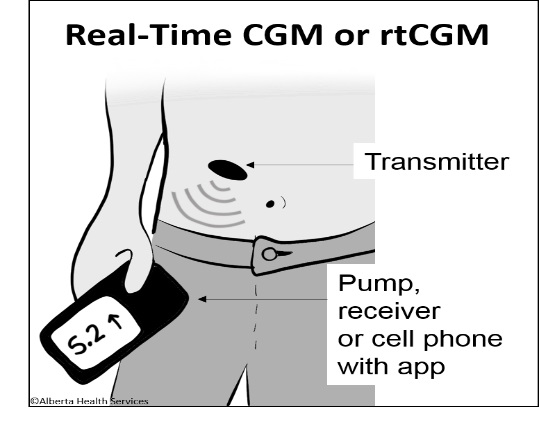 Continuous Glucose Monitoring
