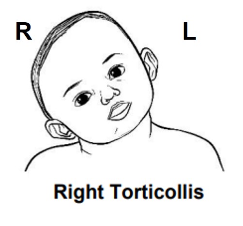 Congenital torticollis in children: Care instructions